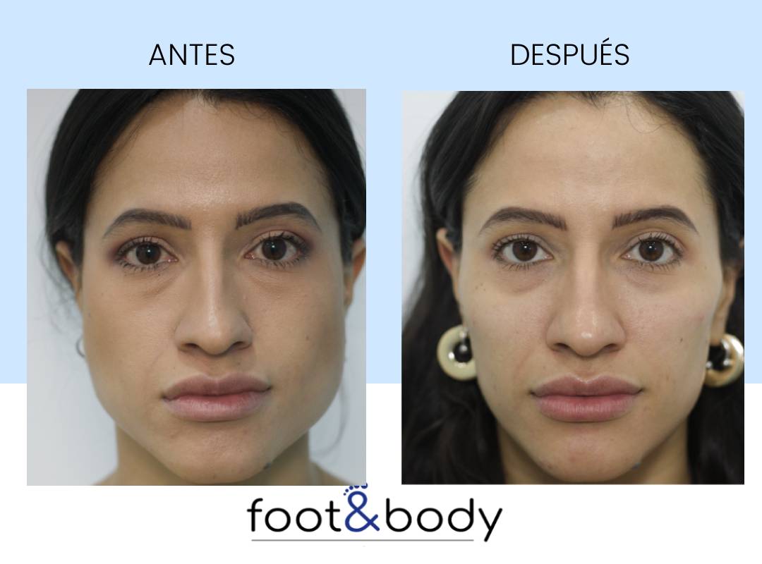Botox - Foot and Body